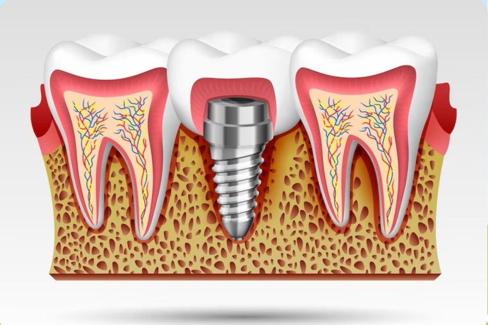 Root Canal Recovery: What to Expect and When